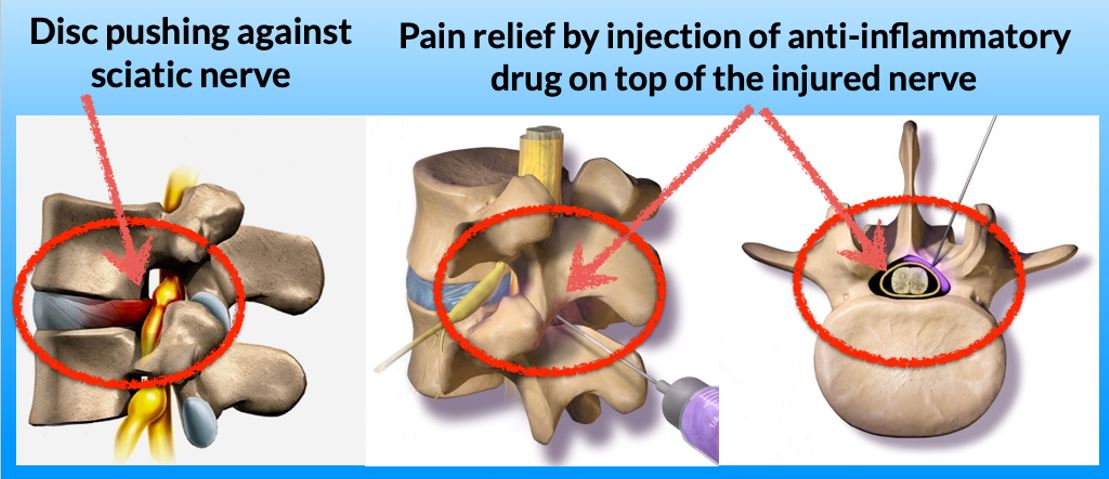 Epidurals | Interventional Pain Management Center